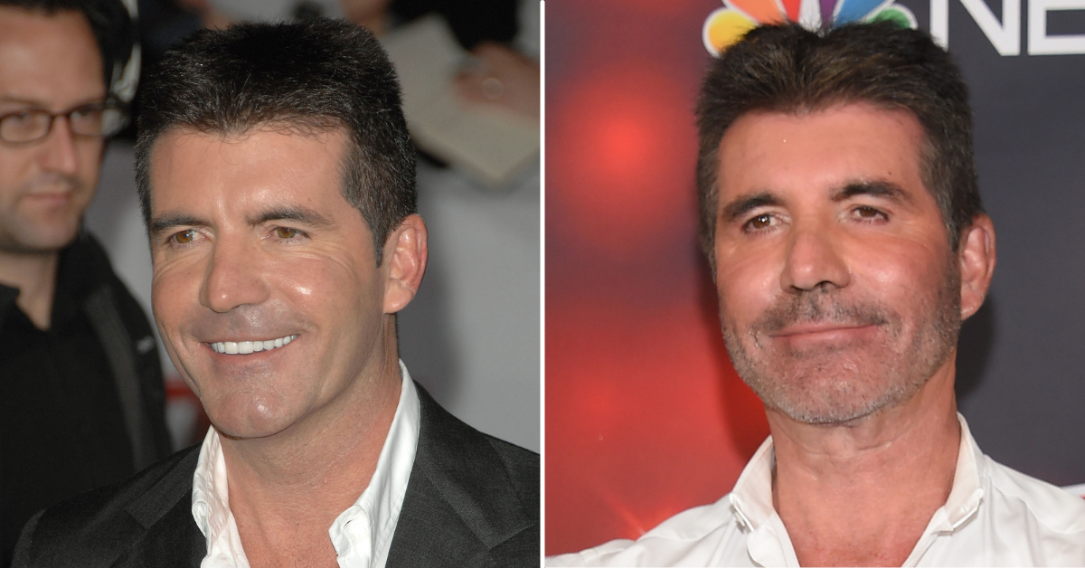 All The Celebs Who Took Face Fillers Too Far, Photos