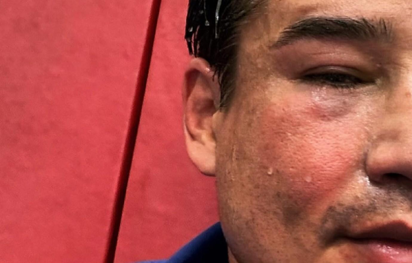Mario Lopez Shows The Power Of Makeup After Getting Black Eye: Photos