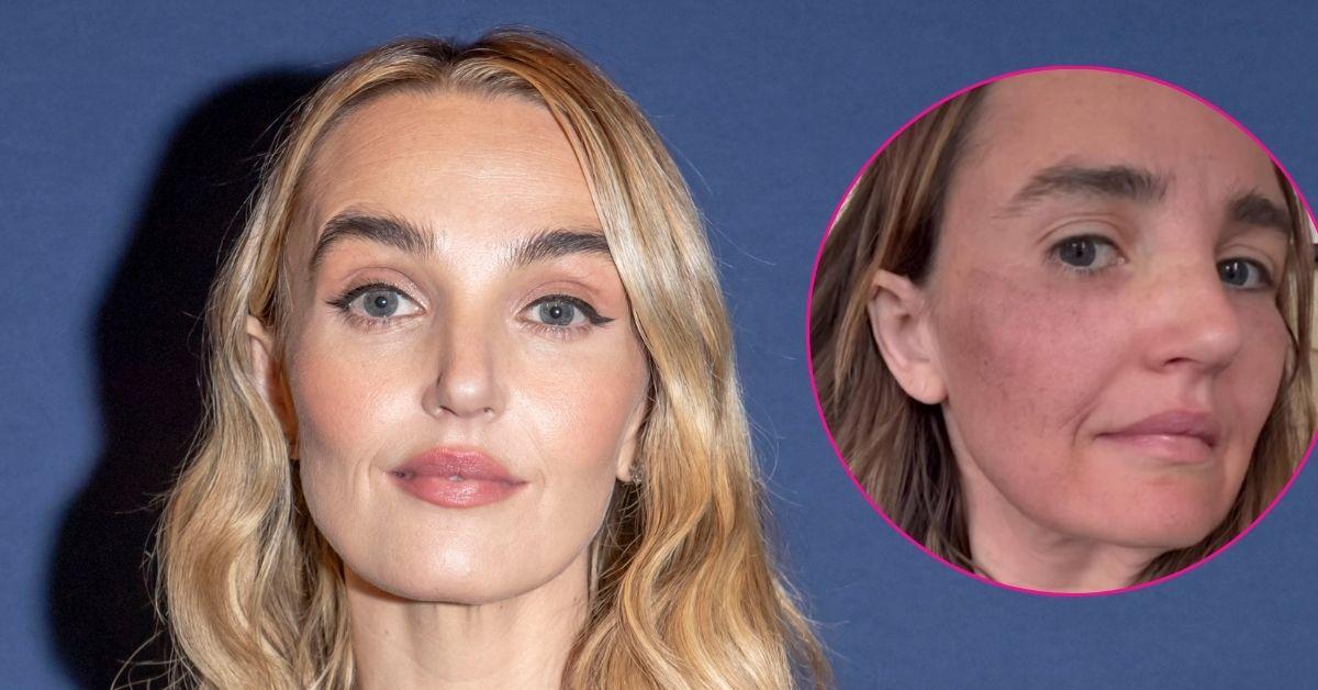 Chloe Fineman's ‘Botched’ Med Spa Saga: Before & After Photos
