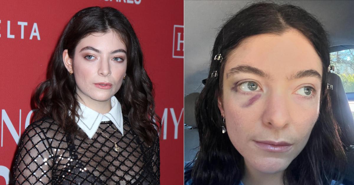 Lorde Worries Fans With 'Concerning' Photos Of Bruised Eye
