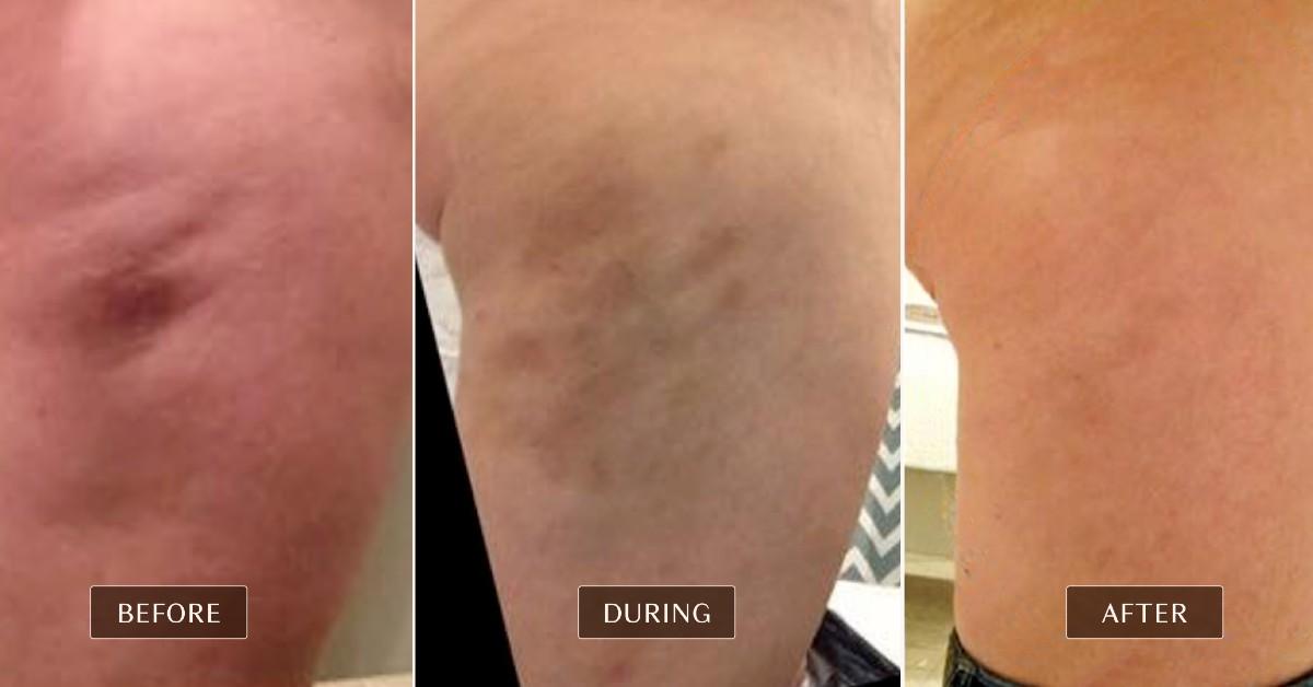 Why Are Celebrities FascialBlastering Their Legs?