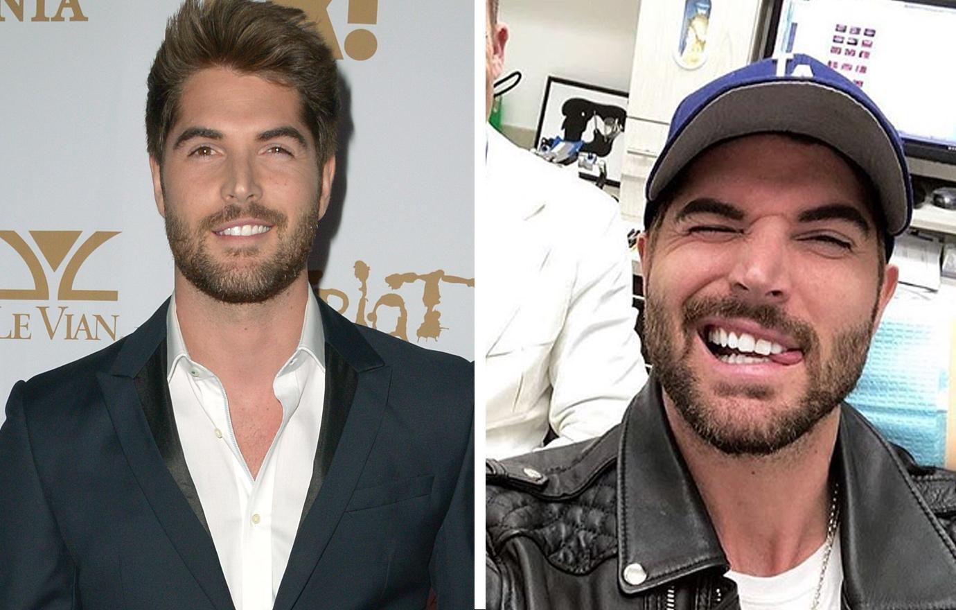 Celeb Byte Before & After Teeth Transformations — Shop Byte Products Now