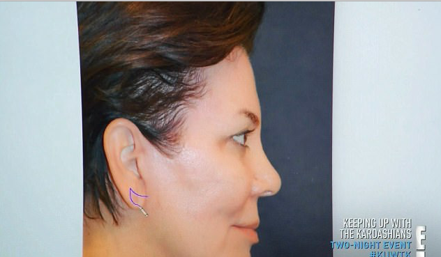 Kris Jenner Confesses To Bizarre Plastic Surgery Procedure