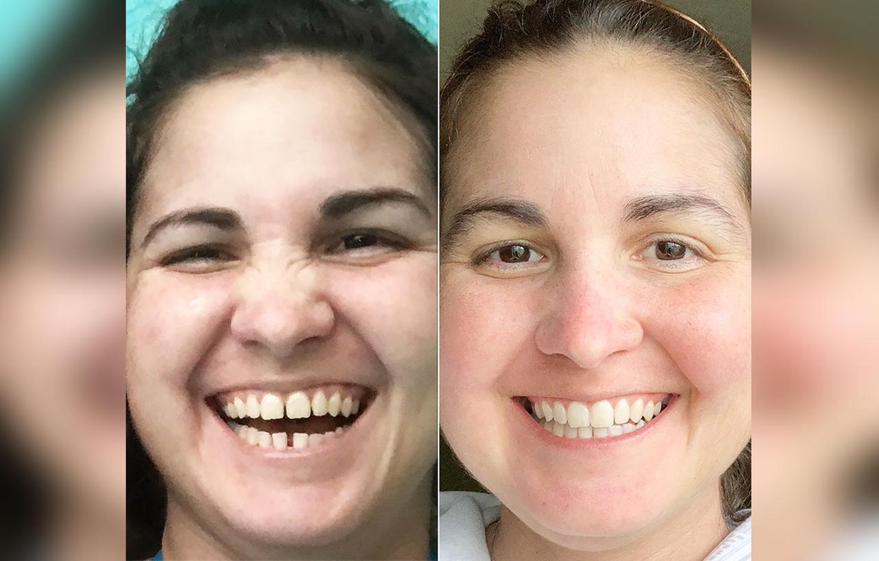 Get $369 OFF Byte Aligners For A Straighter, Whiter Smile