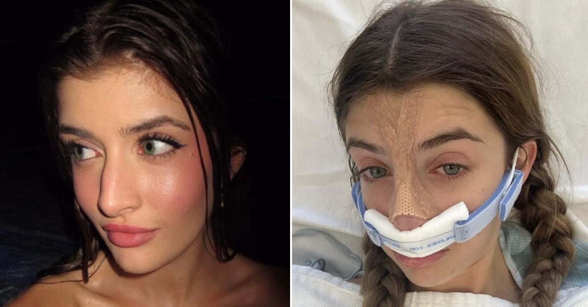 Sami Sheen Gets Nose Job After Breast Implants: Watch