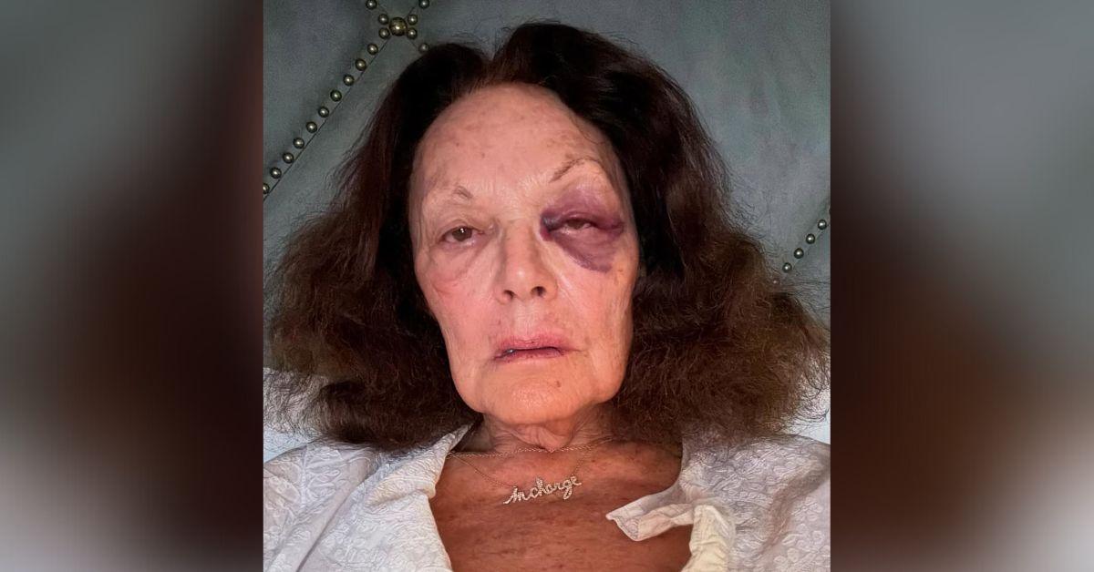 Diane Von Furstenberg Reveals Photo Of Her Bruised Face After Falling