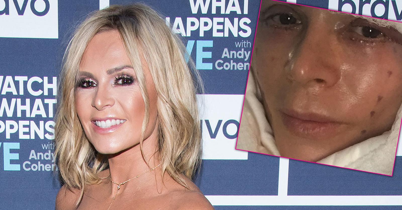 [PICS] Tamra Judge Shares Photos Of Her Face Lift & Plastic Surgery