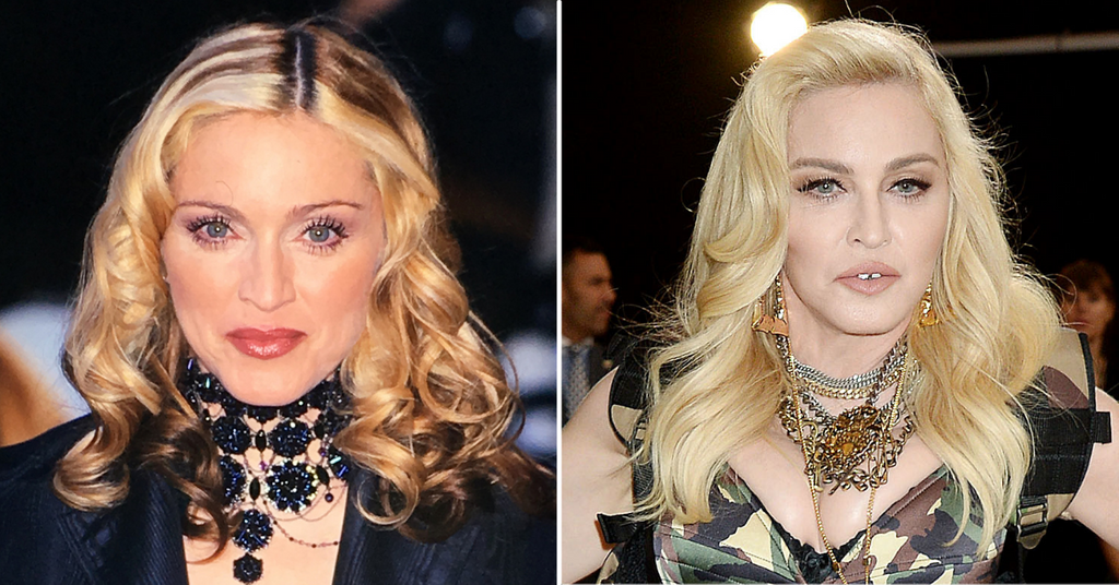 All The Celebs Who Took Face Fillers Too Far, Photos