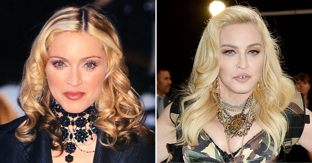 All The Celebs Who Took Face Fillers Too Far, Photos