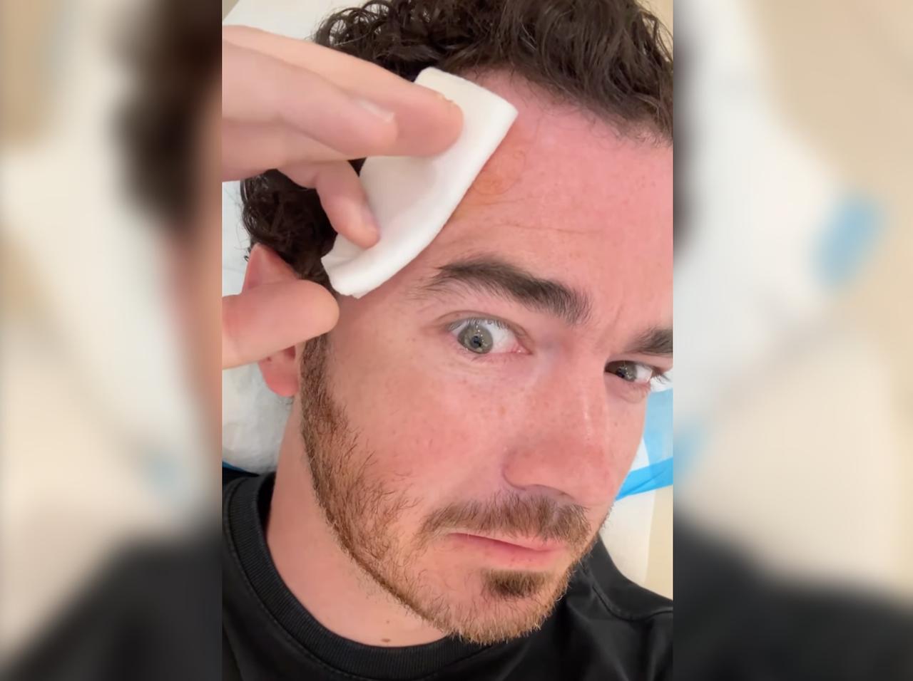 Kevin Jonas Has Skin Cancer Surgically Removed From Forehead