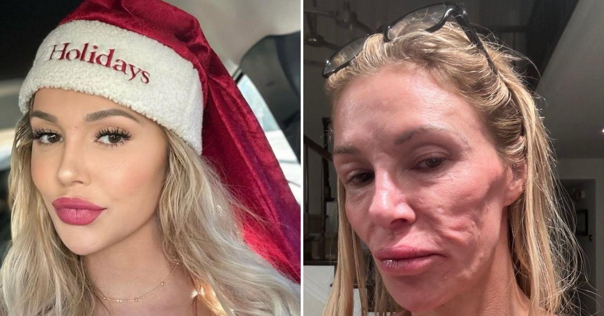 Brandi Glanville Shocks Fans With New Face After Parasite Drama: Photos