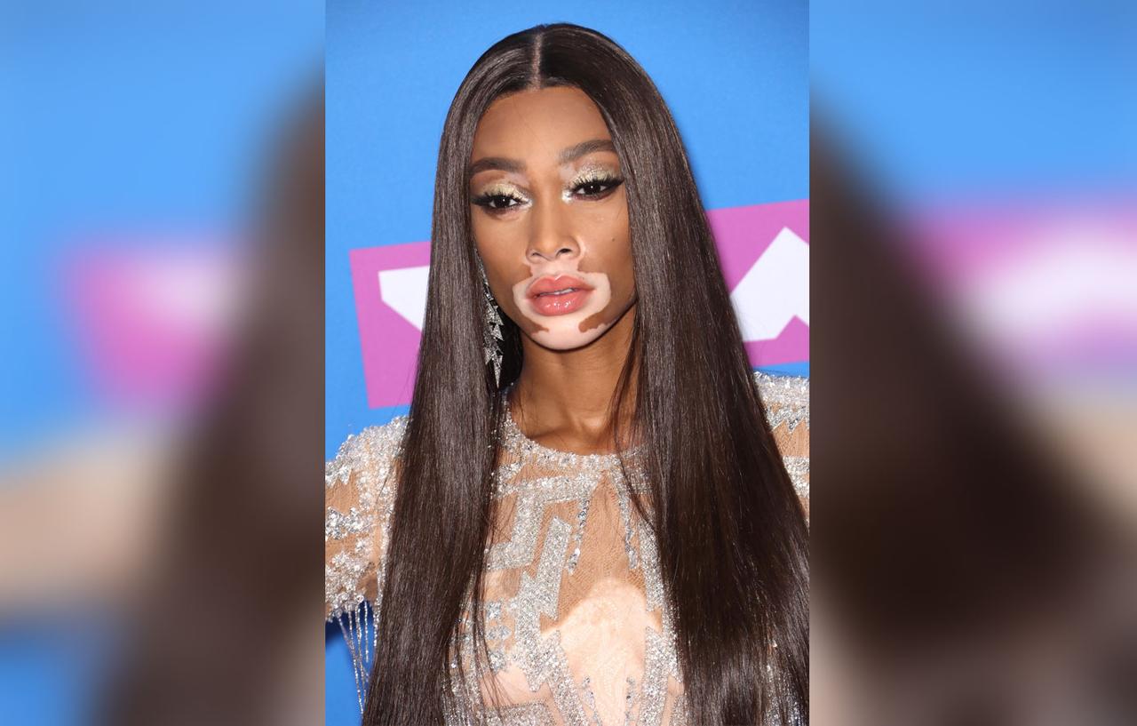 Winnie Harlow Clarifies Her 'America's Next Top Model' Comments Winnie Harlow Clarifies Her 'America's Next Top Model' Comments