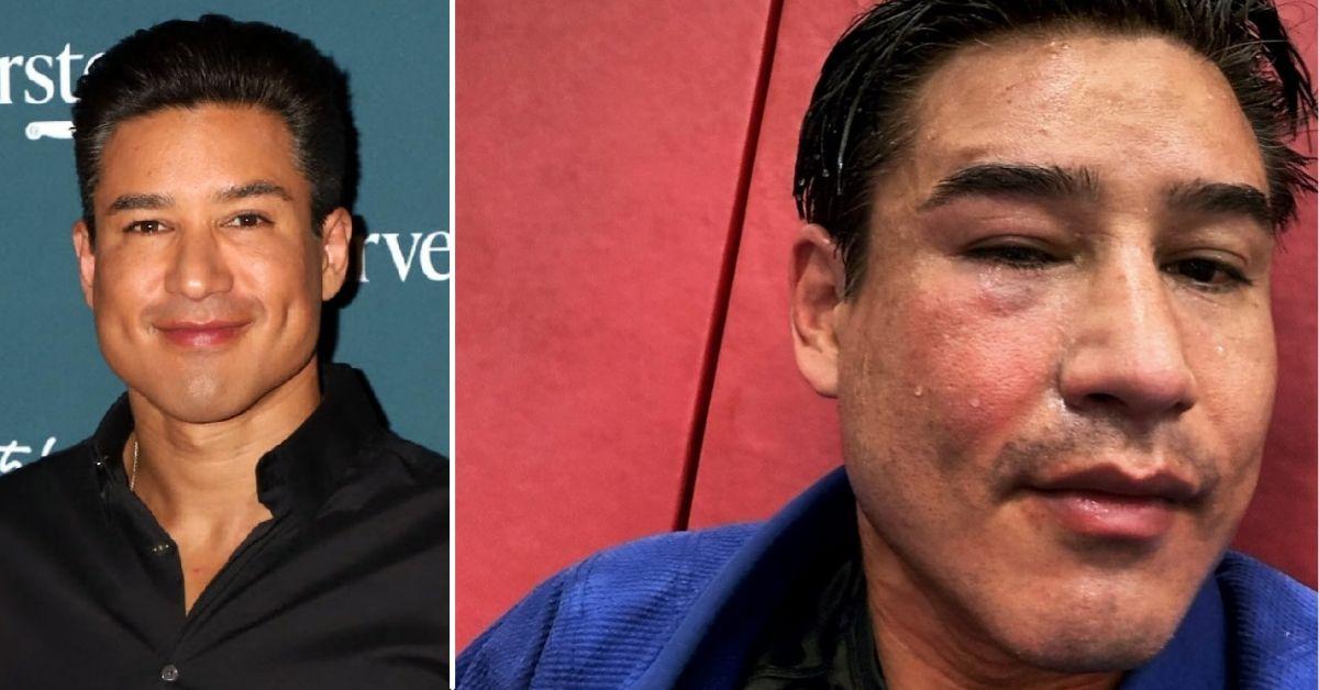 Mario Lopez Shows The Power Of Makeup After Getting Black Eye: Photos