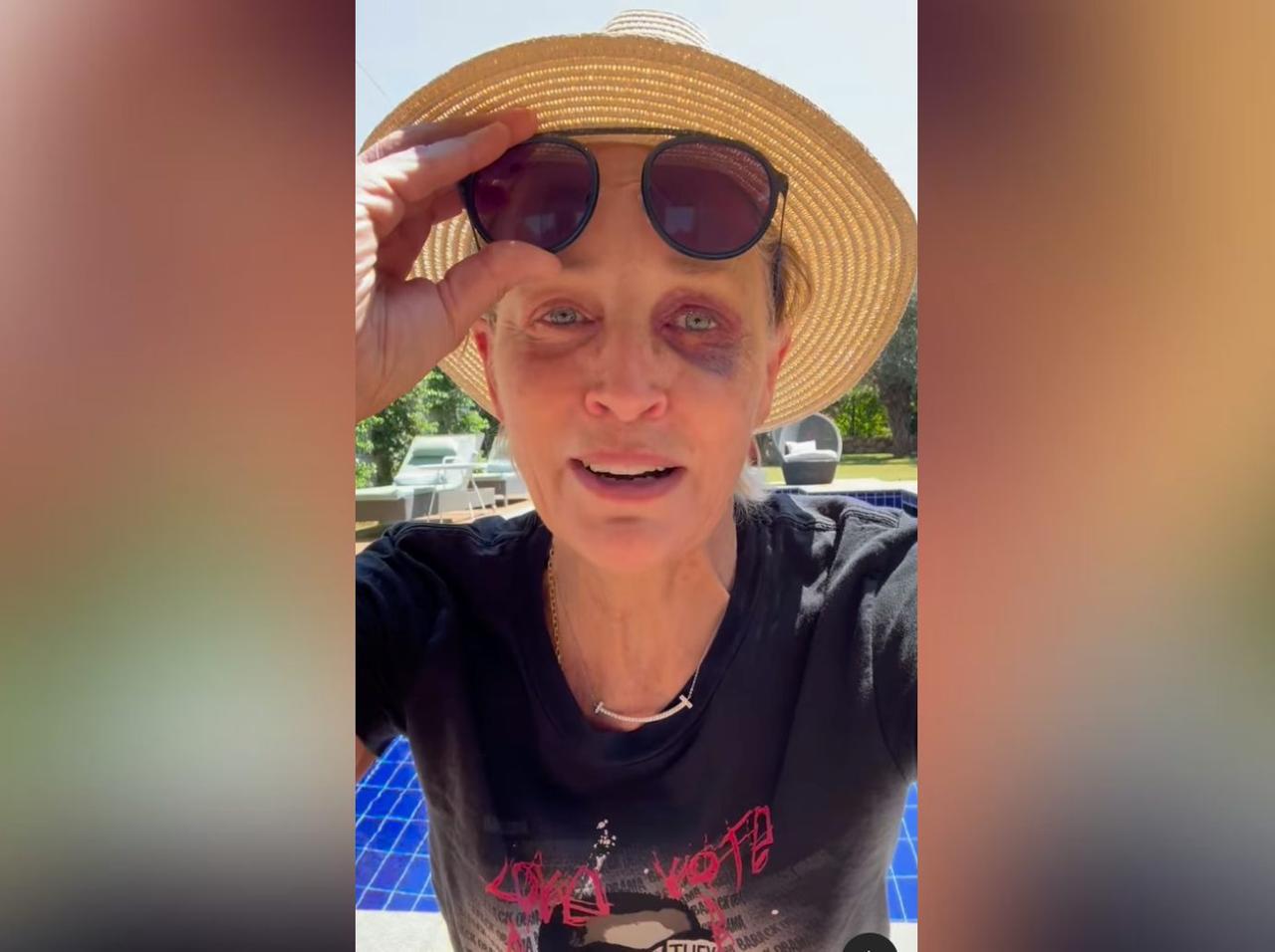 Sharon Stone Shows Off Black Eye After 'Smacking' Her Face Into Marble