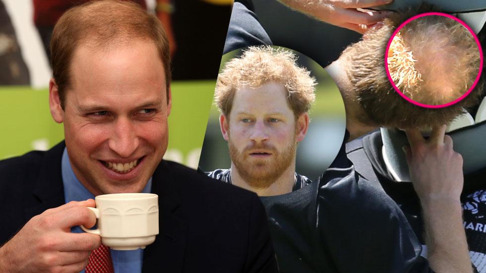 Prince Harry Going Bald After Years Of Poking Fun At Brother Prince ...
