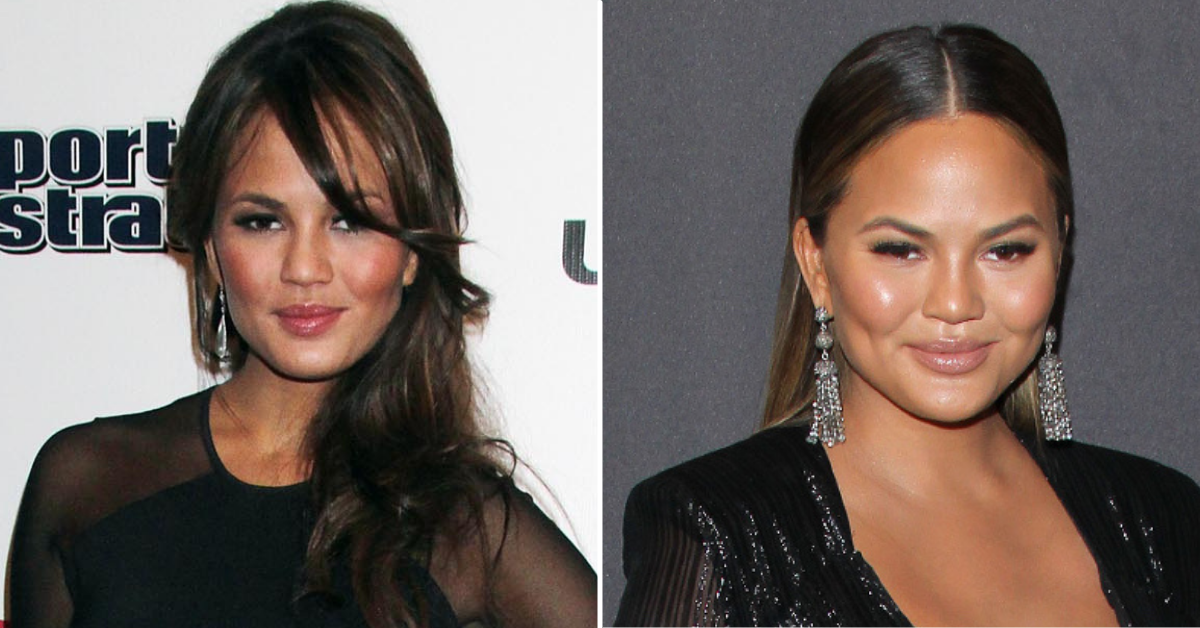 All The Celebs Who Took Face Fillers Too Far, Photos