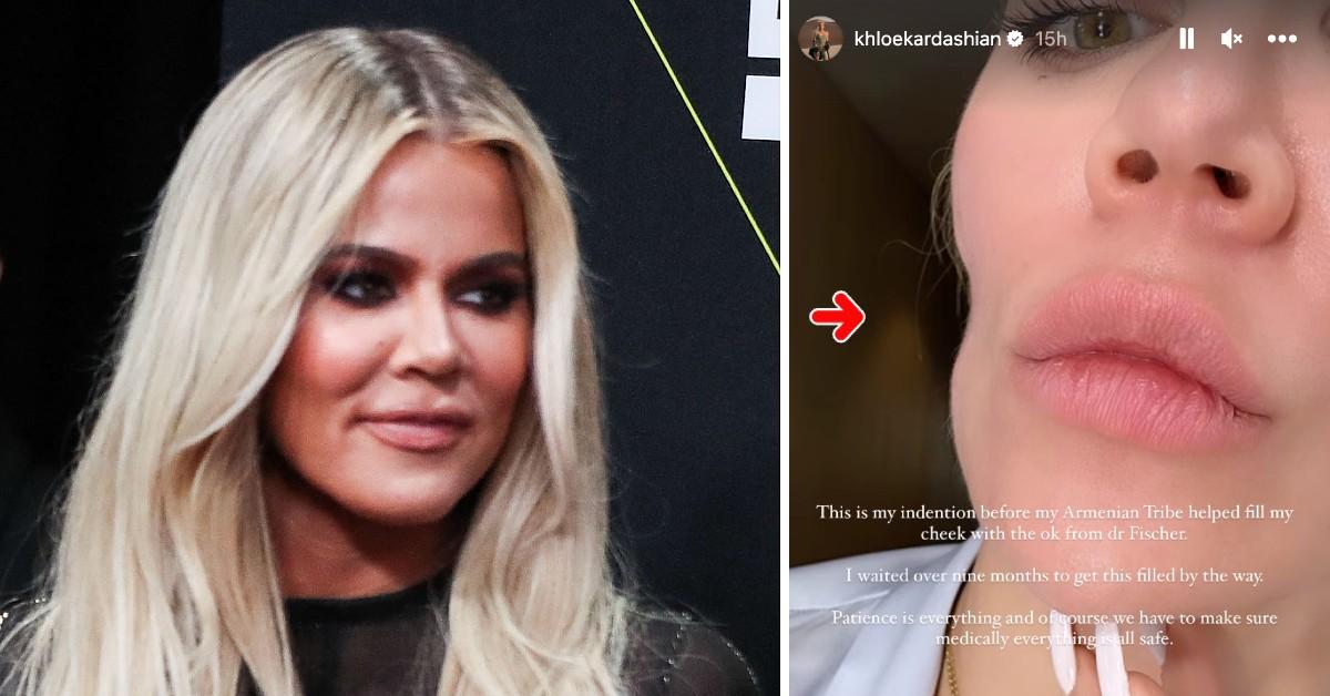 Khloe Kardashian Reveals Face Indentation After Skin Cancer Scare: Pics