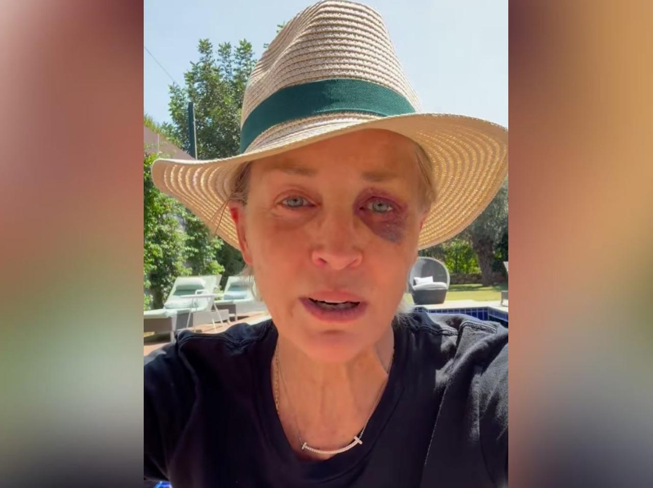 Sharon Stone Shows Off Black Eye After 'Smacking' Her Face Into Marble