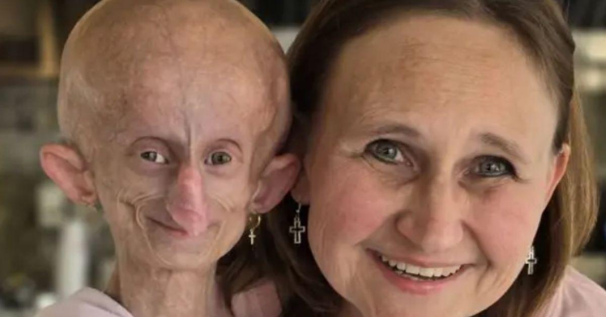 TikTok Star Beandri Booysen Dead At 19 Due To Rare Aging Disease