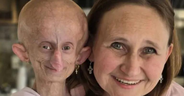 TikTok Star Beandri Booysen Dead At 19 Due To Rare Aging Disease