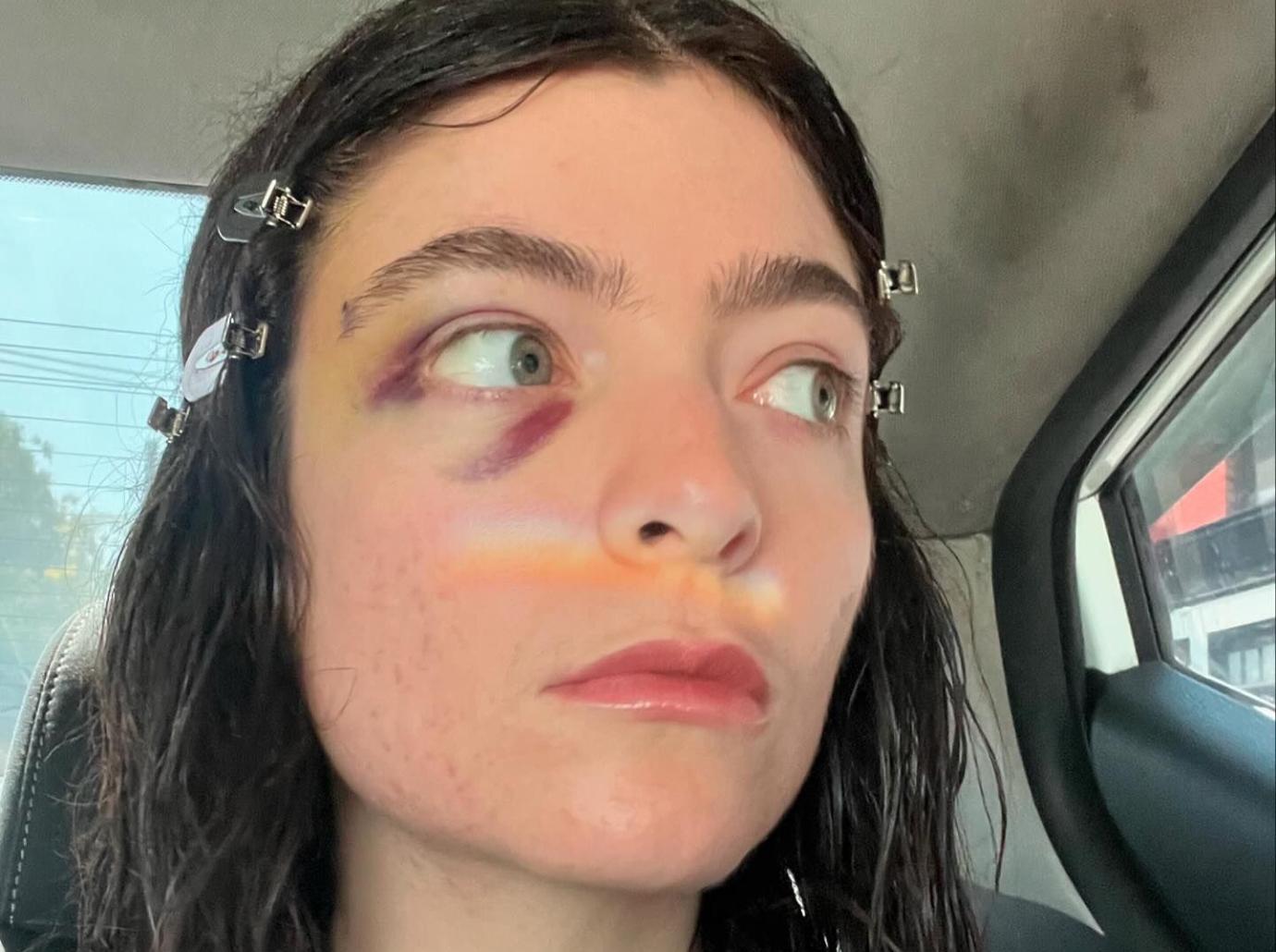 Lorde Worries Fans With 'Concerning' Photos Of Bruised Eye