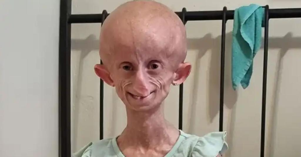 TikTok Star Beandri Booysen Dead At 19 Due To Rare Aging Disease
