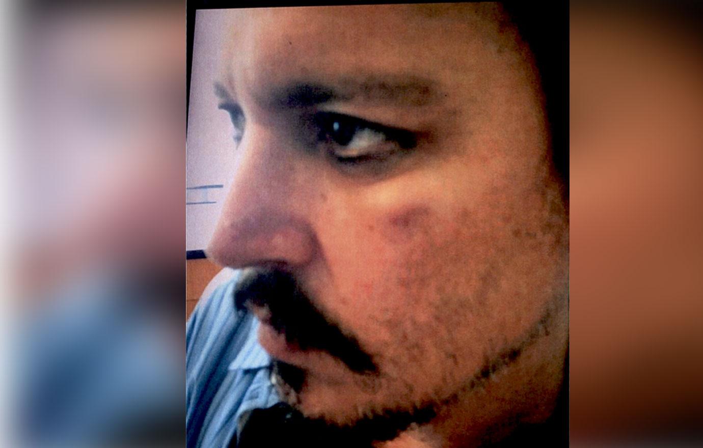 Johnny Depp, Amber Heard Abuse Exhibit Photos